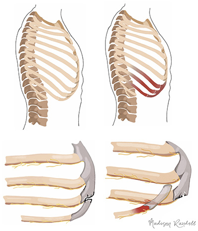 Slipping rib syndrome | Children's Wisconsin
