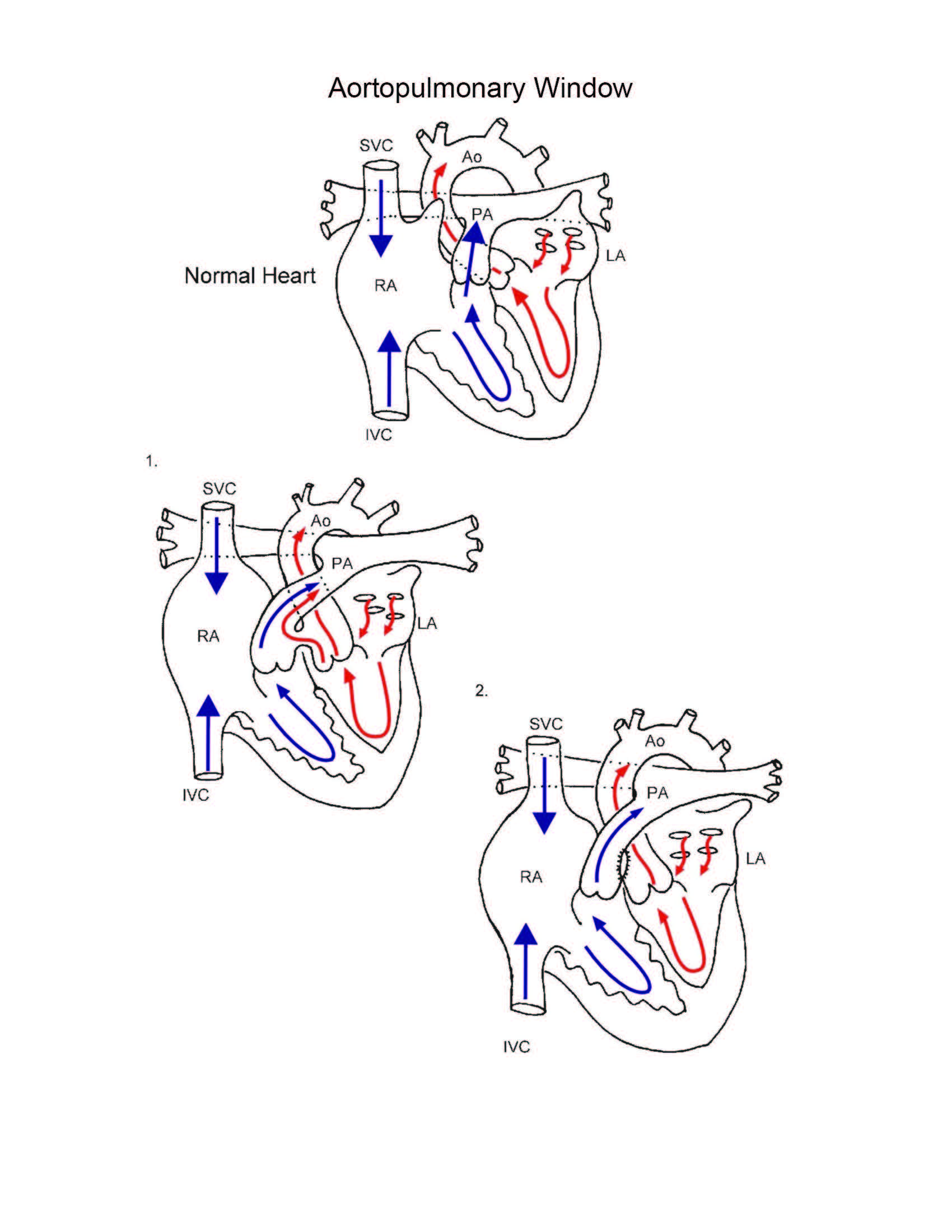 Aortopulmonary window | Children's Wisconsin