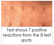 Allergy test results
