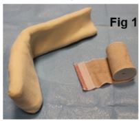 Fractured Elbow Cast