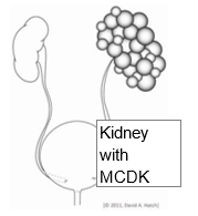 What causes MCDK?