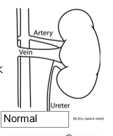 What is multicystic dysplastic kidney (MCDK)?